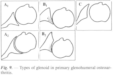 UW Shoulder and Elbow Academy: Primary glenohumeral osteoarthritis ...