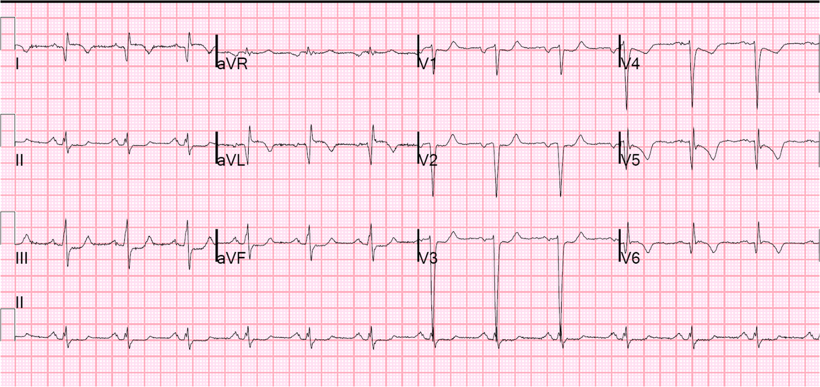 Dr. Smith's ECG Blog: Middle Aged Male with Chest Pain and Previous MI