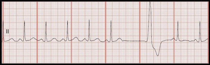 Float Nurse: Basic EKG Rhythm Test Final Exam 2013