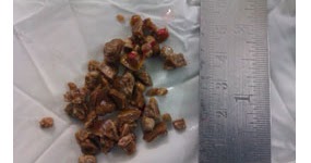 Urinary Stone Disease ~ Kauvery Hospitals