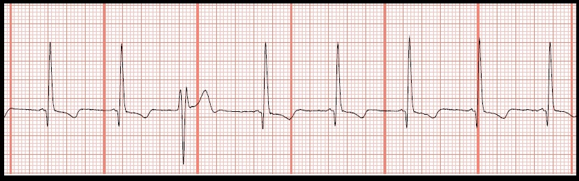 Practice EKG Rhythm Strips 119