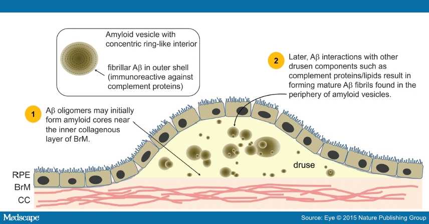 DEGENERACION MACULAR : DRUSAS...en la retina