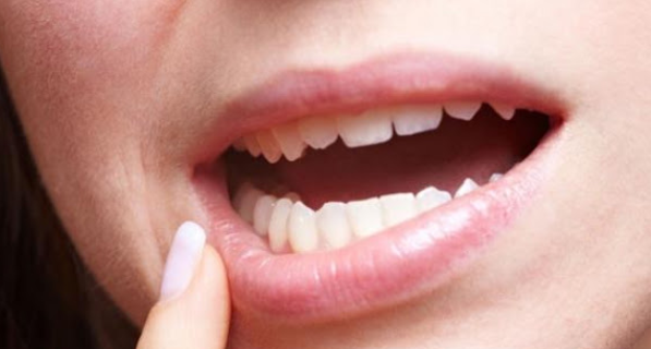 Penyebab dan 13 Cara Ampuh Mengatasi Sakit Sariawan Pada Bibir - Cara ...