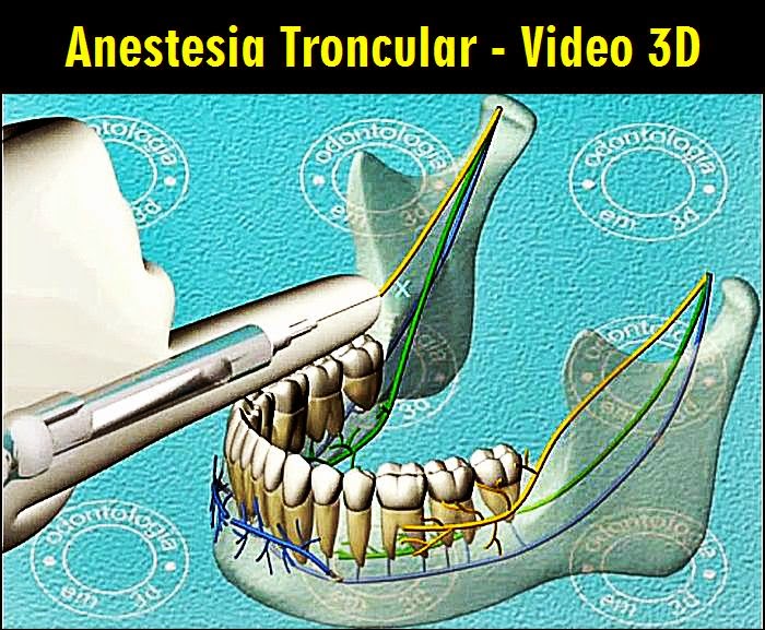 ANESTESIA TRONCULAR del Nervio Dentario Inferior - Video demostrativo en 3D