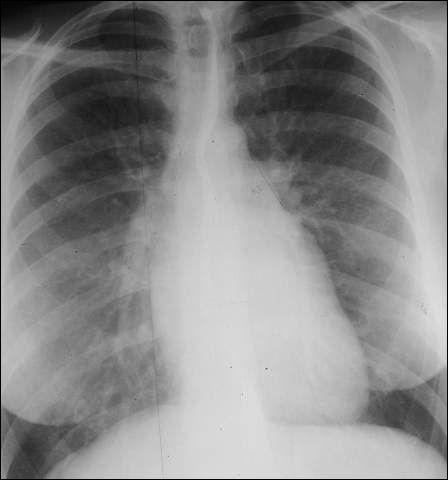 Stenosis Mitral ~ Informasi Kedokteran Dan Kesehatan