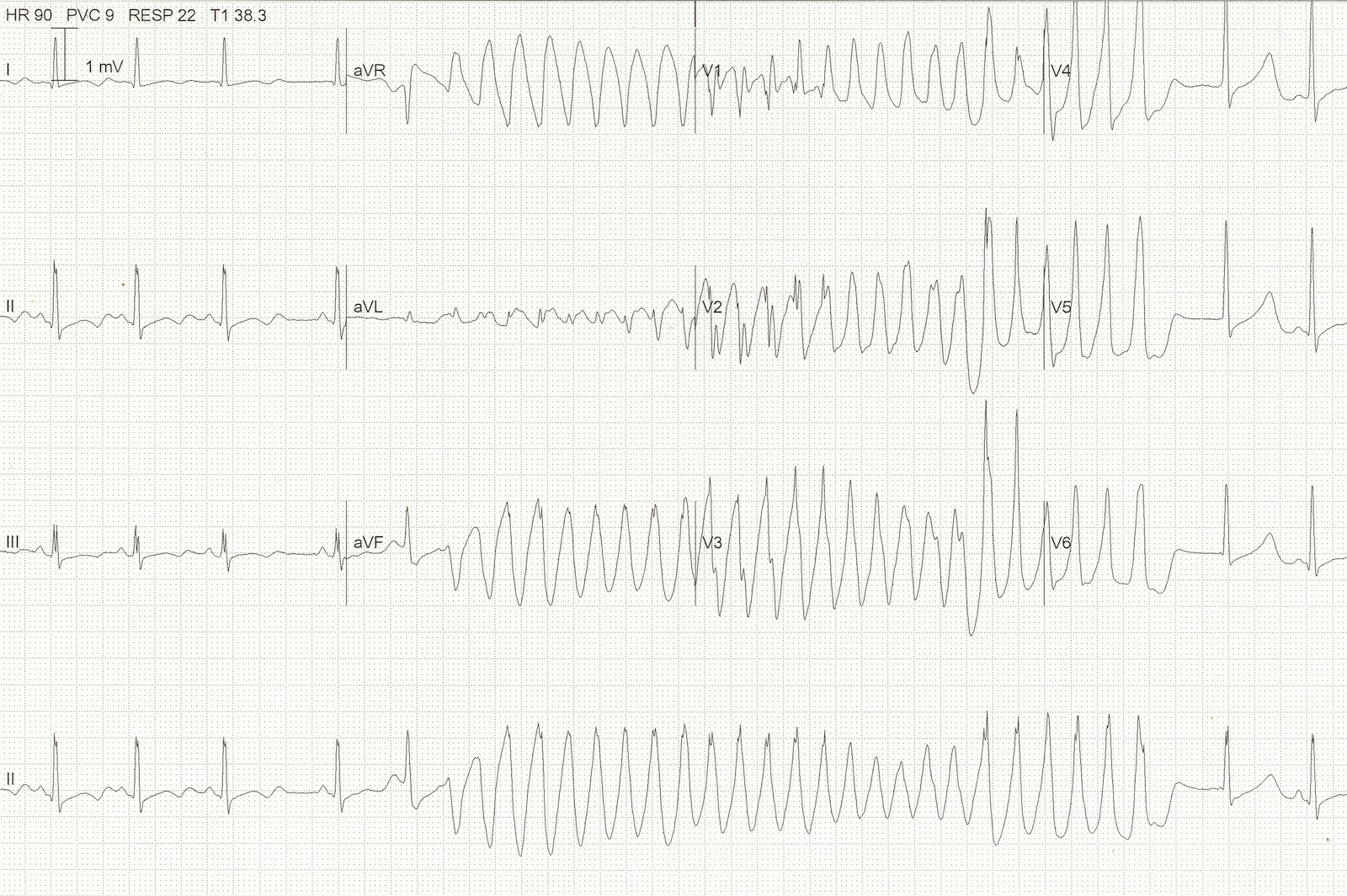 Polymorphic Ventricular Tachycardia | INA - ECG
