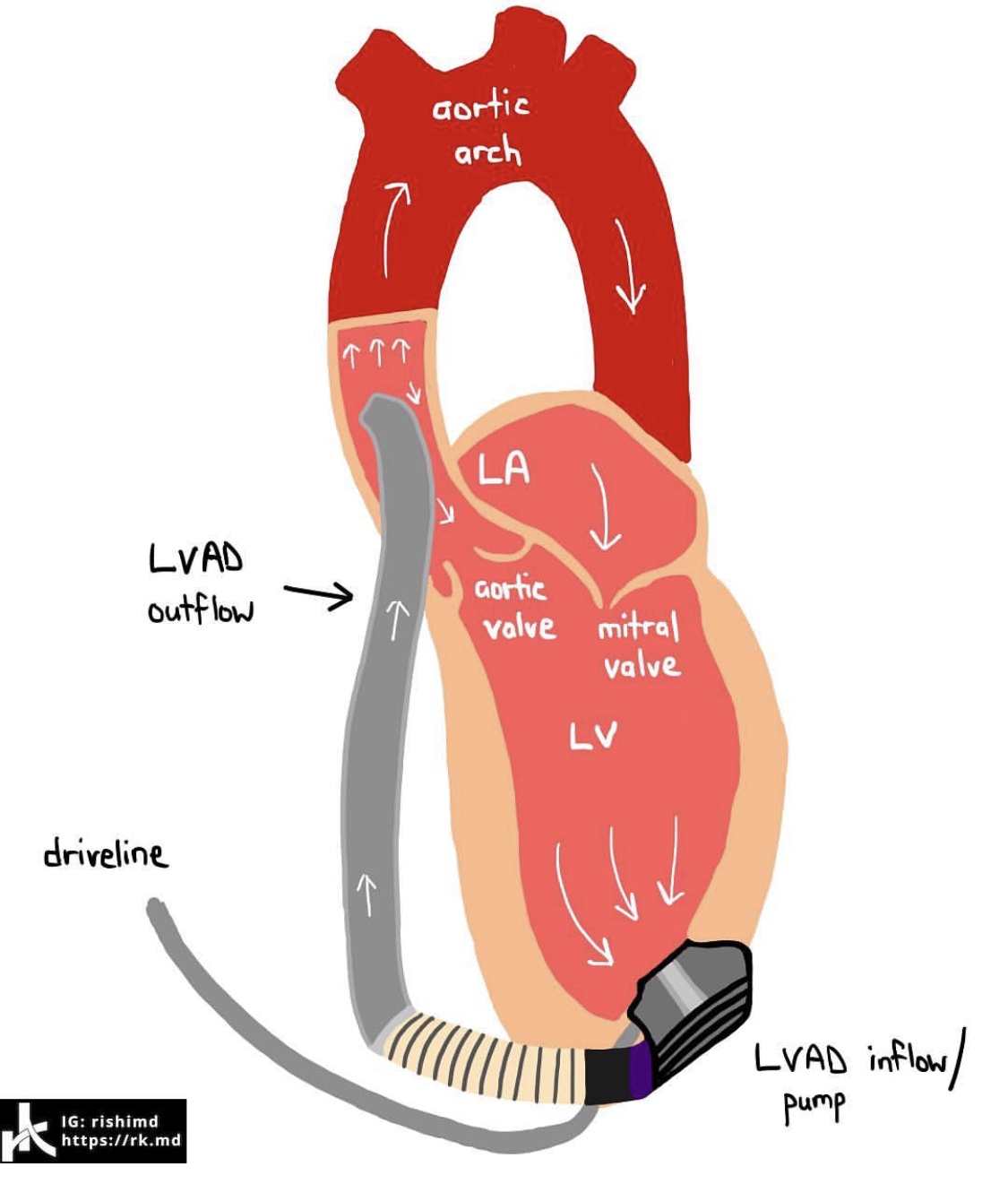 VAD's (LVAD's, RVAD's and BiVAD's)