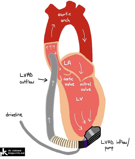 VAD's (LVAD's, RVAD's and BiVAD's)