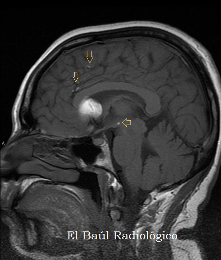 El Baúl Radiológico: 2) QUISTE DERMOIDE INTRACRANEAL (Intracranial ...