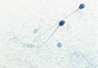 [Haematology] Atlas of Semen Analysis | Free Medical Atlas