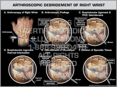 TFCC (Triangular Fibrocartilage complex) tear: Triangular ...
