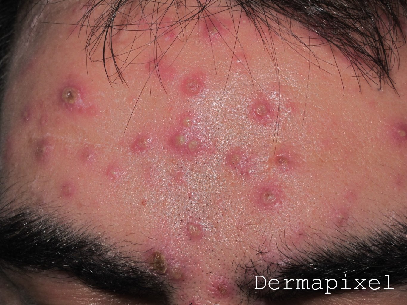 Dermapixel: Varicela con sorpresa