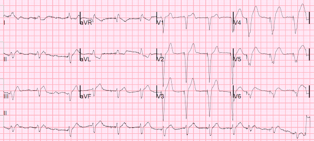 Dr. Smith's ECG Blog: A 50-something with h/o coronary bypass has chest ...