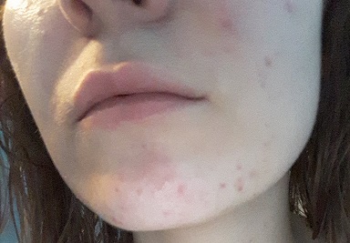 Axotret - jak dbać o siebie ? Skutki uboczne podczas kuracji.