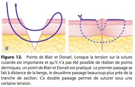 Pansement avec ablation de fils | Récap' IDE