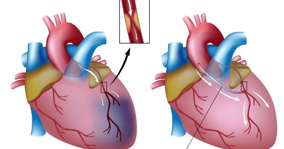 What Is Bypass Surgery ~ Get Updated With Medical News - Yourmedcoach