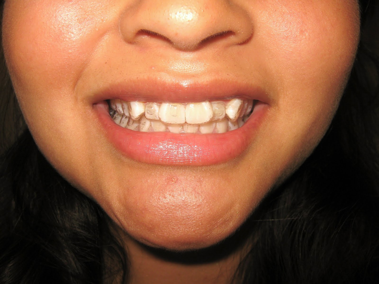 Br@ndy's Invisalign Journey: Tray 3