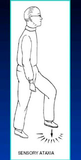 ataxic gait defination | ataxic gait symptoms | ataxic gait meaning ...