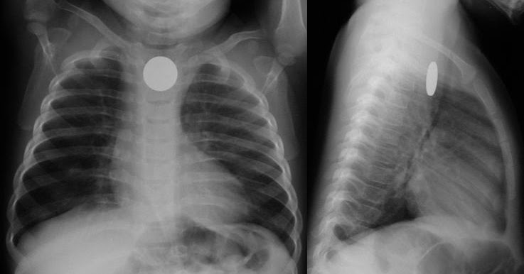 A Deeper Look Into X-Rays: Analyzing An X-Ray