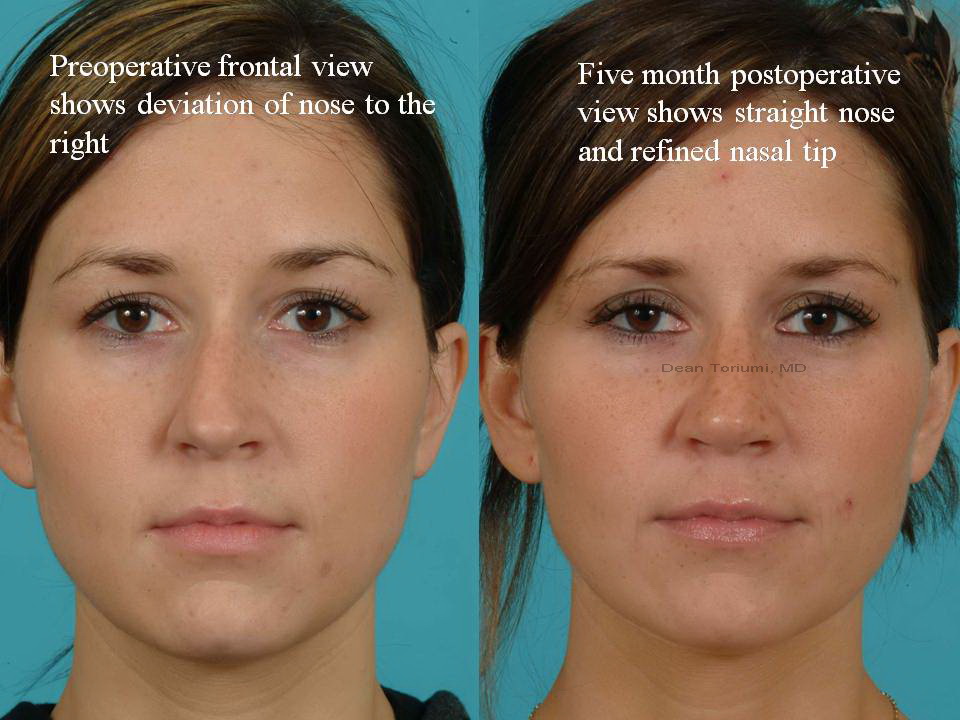 Dr. Dean Toriumi Reviews: Dean Toriumi Reviews: Severely deviated nose ...