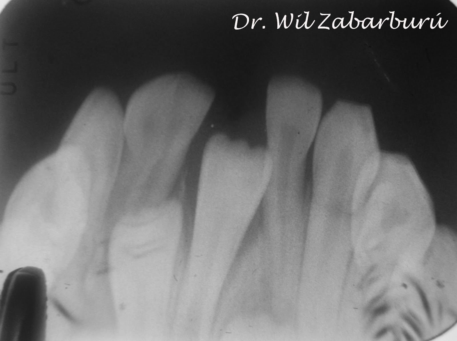 CLINICA DENTAL ASISTENCIAL: NEVUS PIGMENTADO GIGANTE