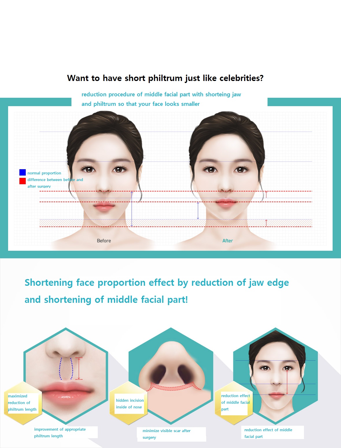 ID Hospital Korea ID Hospital News Article Is The Length Of Philtrum id-hospital-korea-id-hospital-news-article-is-the-length-of-philtrum