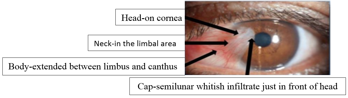 Pterygium, Cause, Symptoms and Treatment - Eye Health Nepal