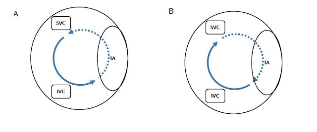 ECG Channel: Atrial Flutter