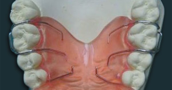 Dental Library: Bite Plates