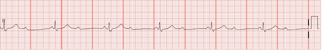 EKG Rhythm Strip Quiz 35