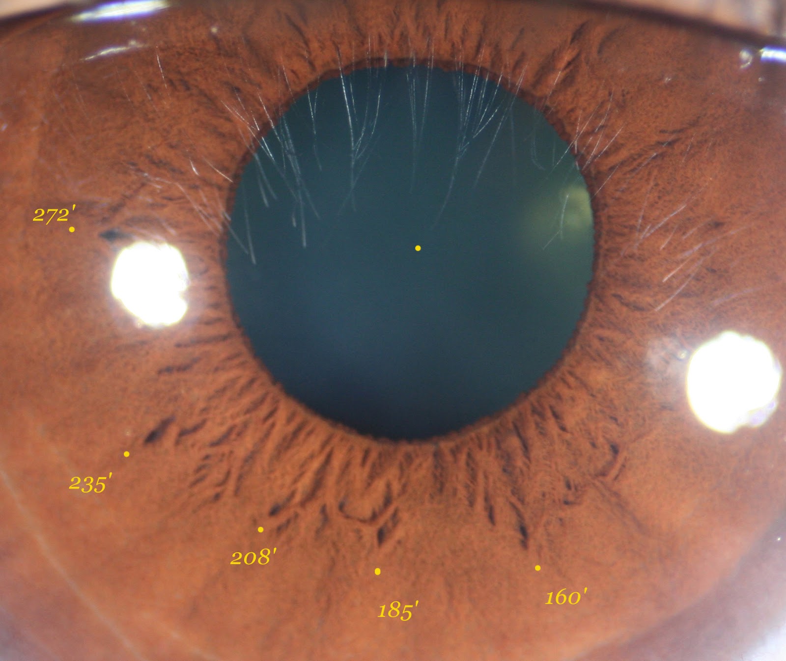 Modern & Multidimensional Iridology: Crypts at Pupillary Zone ...