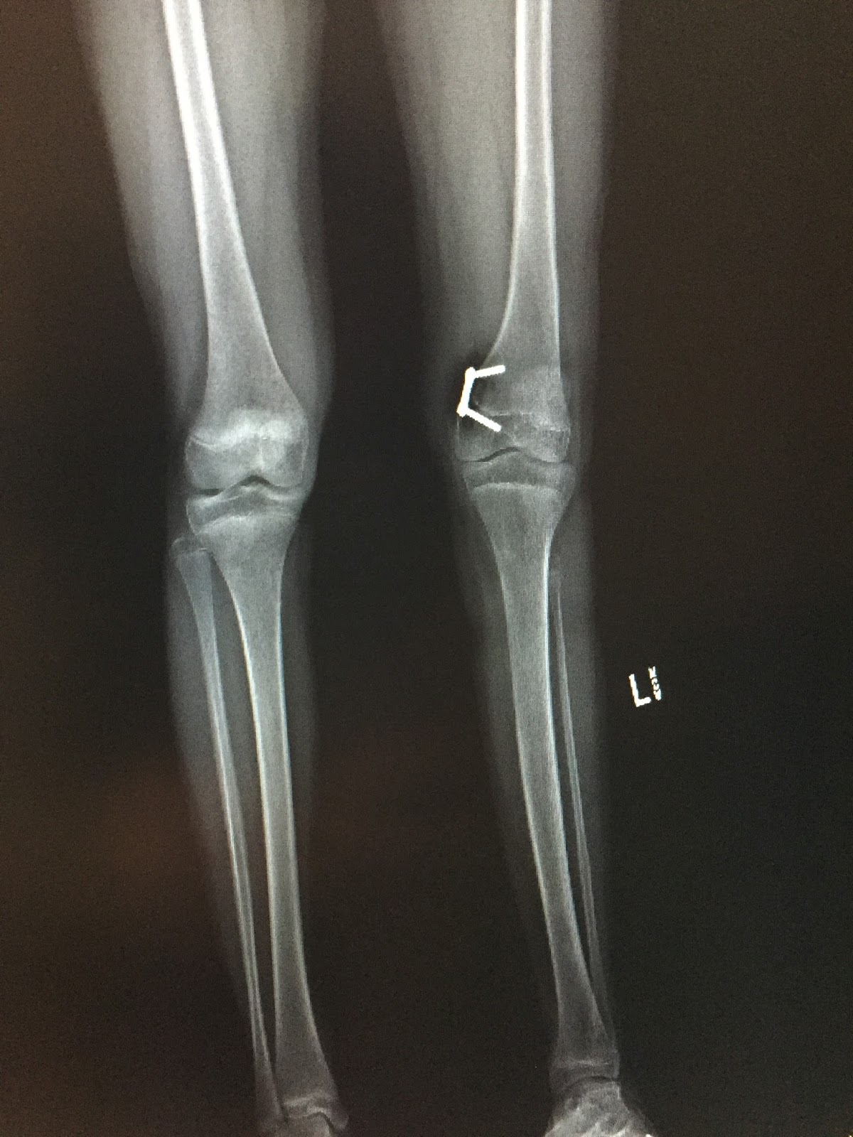 fibular hemimelia leg lengthening: Pre-Op for Epiphysiodesis