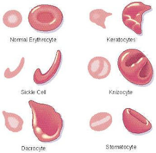 Kelainan Bentuk Eritrosit | Uchaal