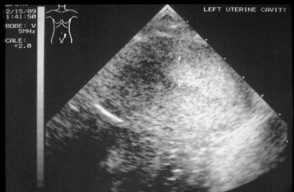 Alabama Fertility Update Bicornuate Or Septate Uterus Part 2