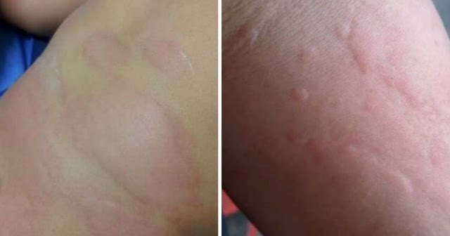 Orang Kampung Cakap Ini Kena Ludah Jin!! Nah Cara-Cara Merawat Penyakit ...