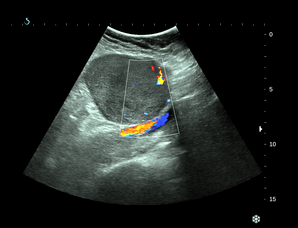 VIETNAMESE MEDIC ULTRASOUND: CASE 361: TUMOR of MUSCLE RECTUS ABDOMINIS ...