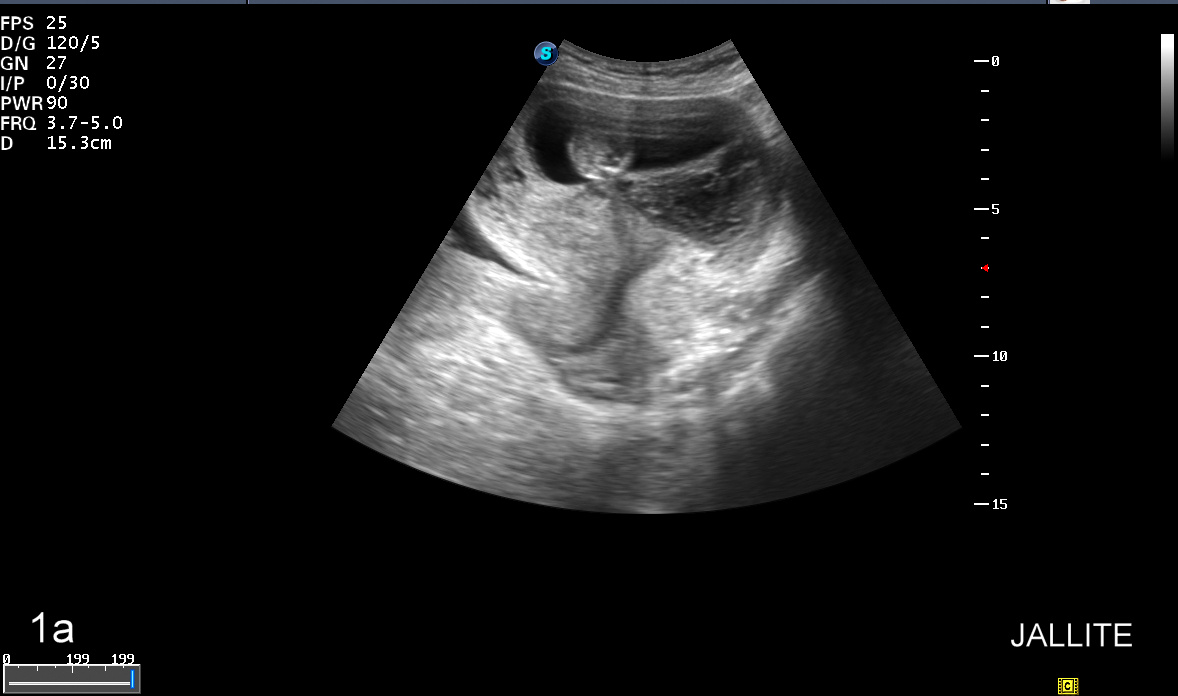 Hematoma Retrocorionico & Placenta Marginal
