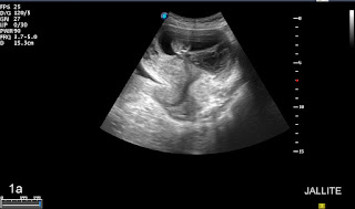 Hematoma Retrocorionico & Placenta Marginal