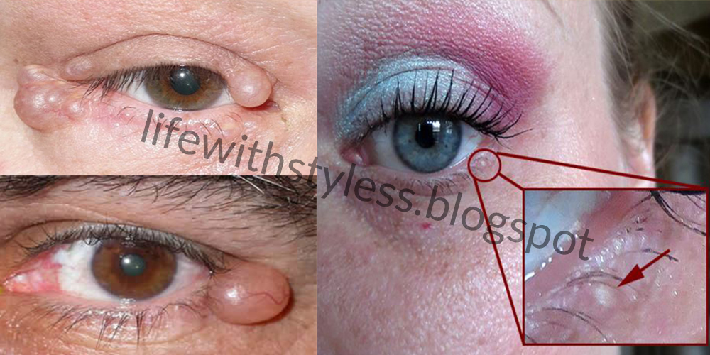 Eyelid Cyst
