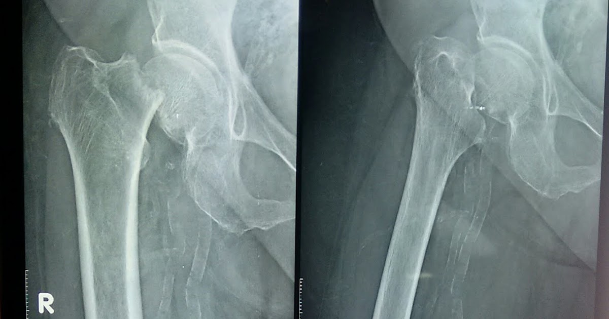 Subcapital fracture Neck Of Right Femur ~ Materialnotes.com- Staff ...