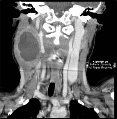 Radiologist For Ever: Neck rule 6 :Branchial cleft cyst