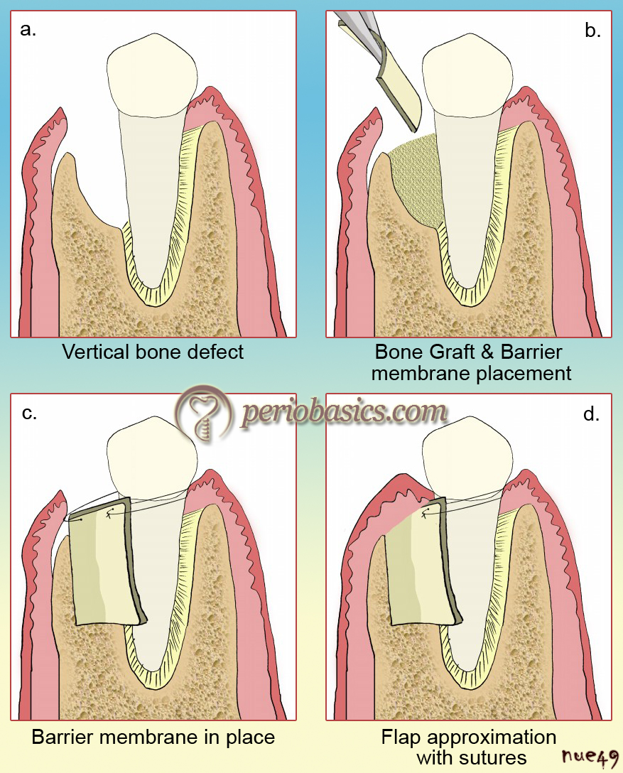 career: Using Stem Cells to Heal Broken Bones 06-08