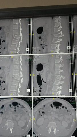Neurochirurgie / جراحة الأعصاب / neurosurgery: fracture du rachis avec ...
