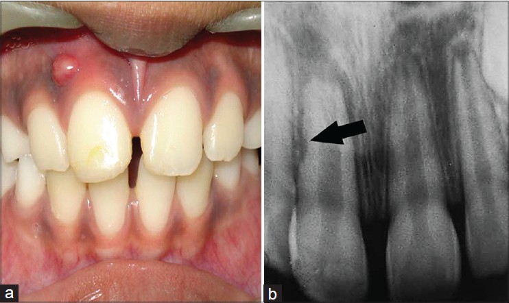Diari Doktor Gigi: Gigi Mati (Pulp Necrosis)
