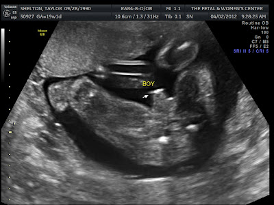 Growing Baby Shelton: Growth Ultrasound and ECHO