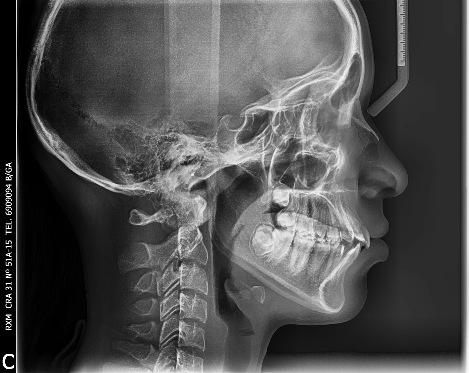 rayosxmaxilofacial: radiografia cefalica lateral y cefalometria