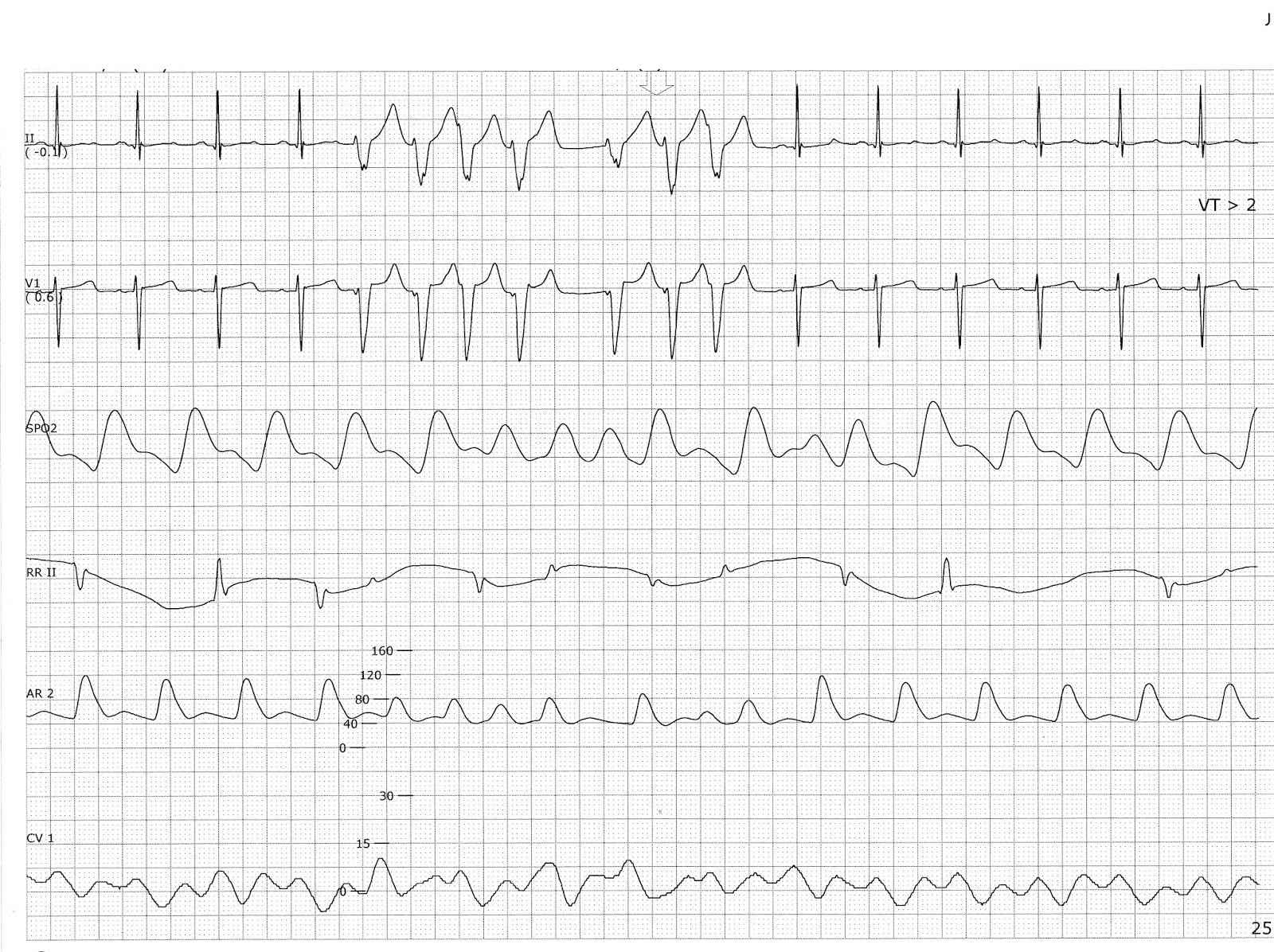 Sinus rhythm with a short run of VT and hemodynamic effects on the ...