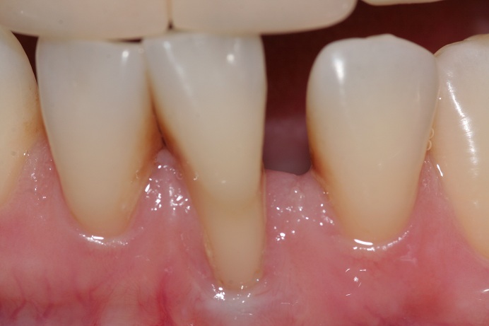 Retração Gengival ~ Dentaris Odontologia
