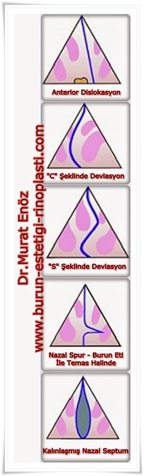 Open Technique Septoplasty