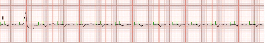 EKG Rhythm Strip Quiz 32